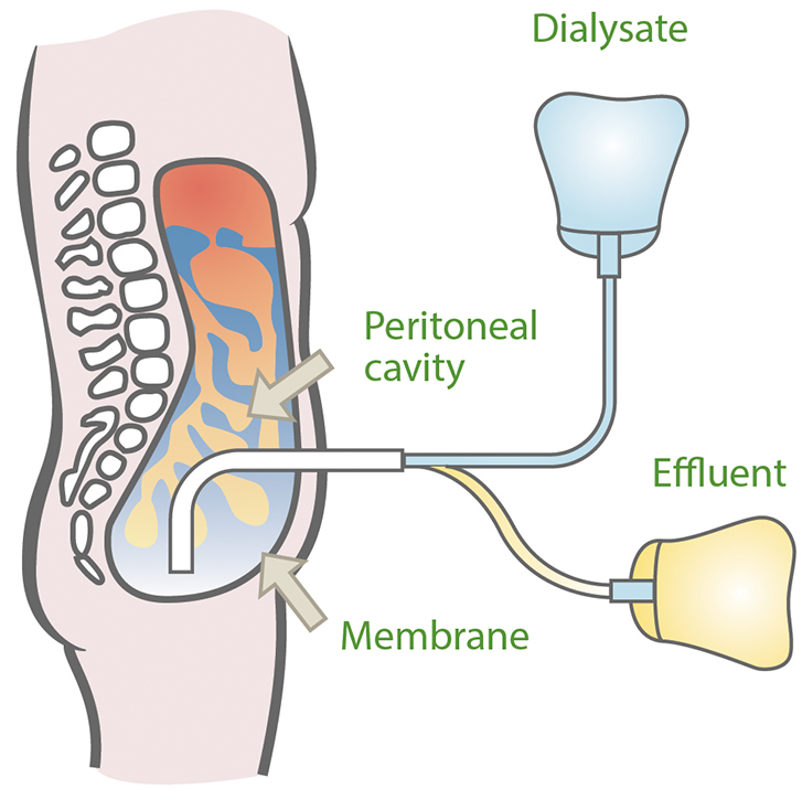 Peritoneal Dialysis Catheter Types